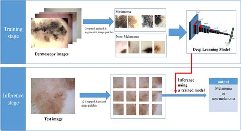 The Framework Of The Melanoma Classification Showing Training Upper
