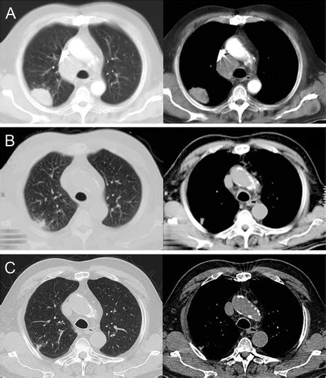 Initial Chest Computed Tomography Scan Showing The Tumor In The Upper