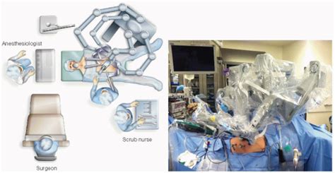 Abdominoperineal Resection Robotic Assisted Laparoscopic Surgery