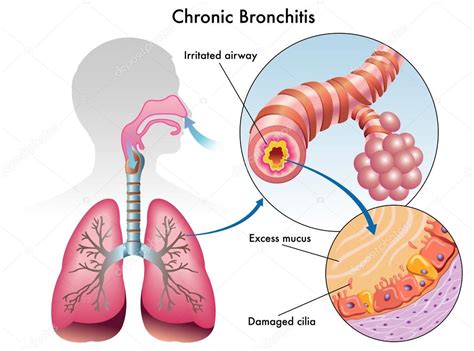 Chronic Bronchitis Stock Vector Image By ©rob3000 60338273