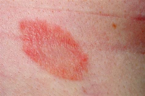 Herald Patch In Pityriasis Rosea Photograph By Dr P Marazzi Science