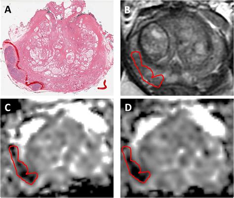 Repeatability Of Diffusion Weighted Mri Of The Prostate Using Whole
