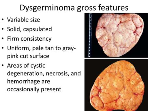 Germ Cell Tumors Of Ovary