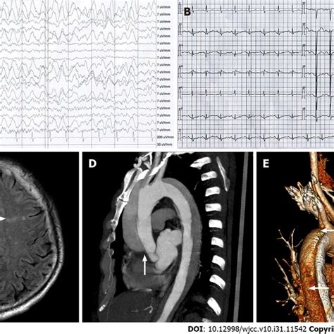 Examination Results A Electroencephalogram Showed A Lot Of 2 3 Hz