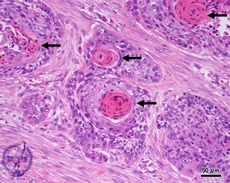 Squamous Cell Carcinoma Lung Keratin Pearls