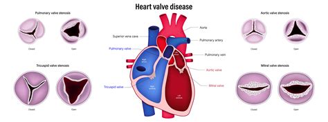 Heart Valve Replacement Understanding Heart Valve Diseases And