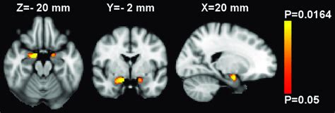 region of interest voxel based morphometry analysis of gray matter mass