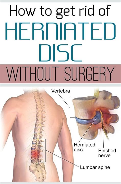 How To Get Rid Of Herniated Disc Without Surgery