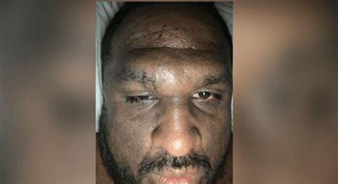 Man Hospitalized With Flesh Eating Bacteria He Got At The Beach Wkrc