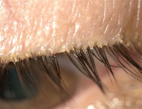 ed holland asks if demodex blepharitis treatment is the next big thing