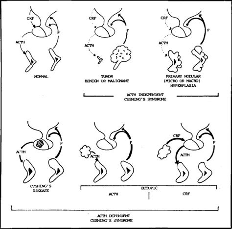 Cushings Syndrome Update Of Diagnosis And Management Mayo Clinic
