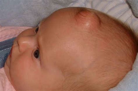 How To Get Rid Of Epidermoid Cysts Remove Sebaceous Cyst Naturally