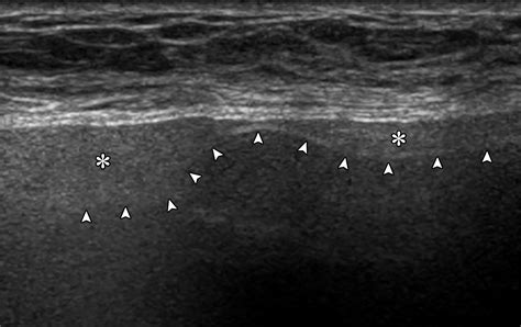 multimodality imaging based evaluation of single lumen silicone breast
