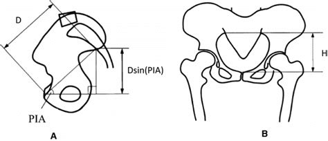 The Method For Calculating The Pelvic Inclination Angle Pia [15] A