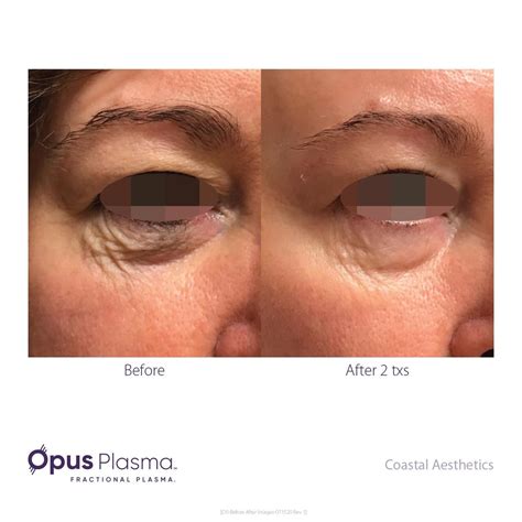 Opus Plasma Laser Specialist Oakbrook Terrace Il Christopher
