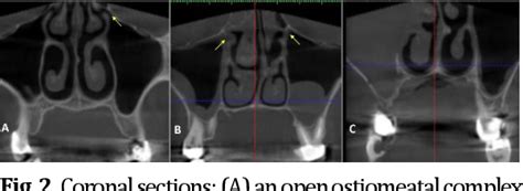 Figure 2 From Relationship Of Maxillary Sinus Mucosal Thickening And