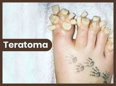 Sacrococcygeal Teratoma Teeth