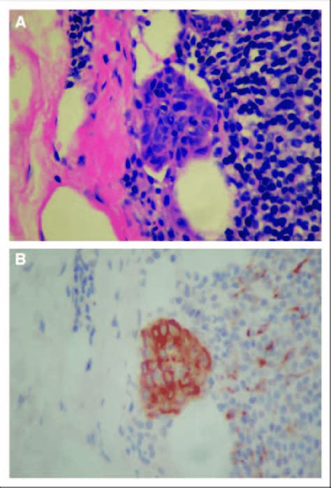 Benign Epithelial Cells In A Cohesive Cluster In A Peripheral Sinus Of