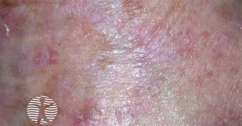 Dermnet® Actinic Keratoses Affecting The Hands Image