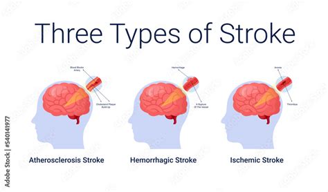 Ischemic Stroke Diseases Stage Anatomy Diagram Vector Illustration