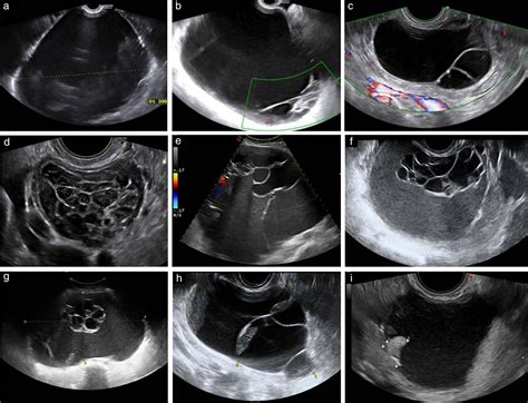 Serous Cystadenoma Ultrasound