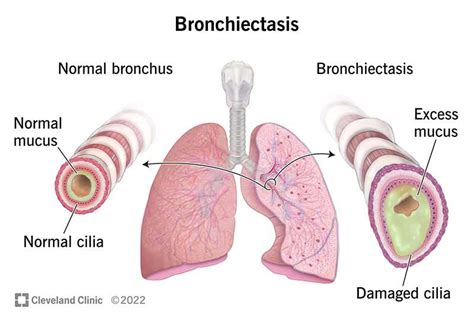 Understanding Bronchiectasis Causes Symptoms And Treatments Ask