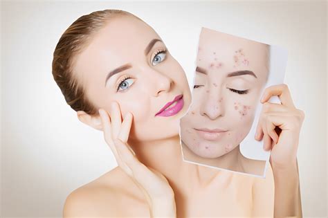 Fungal Acne Vs Closed Comedones What You Need To Know Skin Gleam