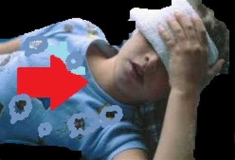 Cyclic Vomiting Syndrome Causes In Adults