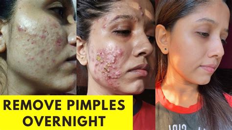 How To Remove Pimples Overnight Acne Treatment Get Clear Glowing