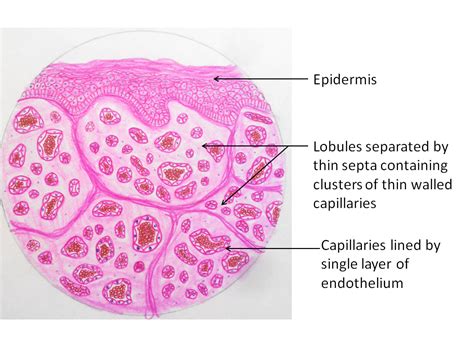 Capillary Hemangioma Pathology Made Simple