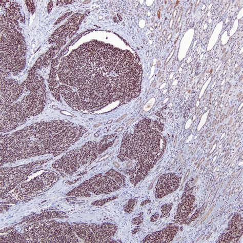 Wilms Tumor 1 Wt1 Wt 1 Pathology Resident Wiki Fandom