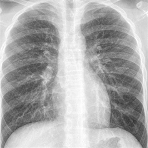 Pneumonia Chest X Ray Vs Normal