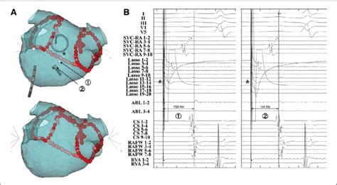 Three Dimensional Electroanatomic Map Carto Image And Intracardiac