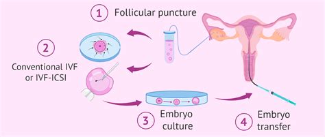 In Vitro Fertilization Ivf Conventional – Slavica