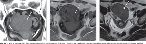 Table 1 From Sex Cord Stromal Tumors Of The Ovary A Comprehensive
