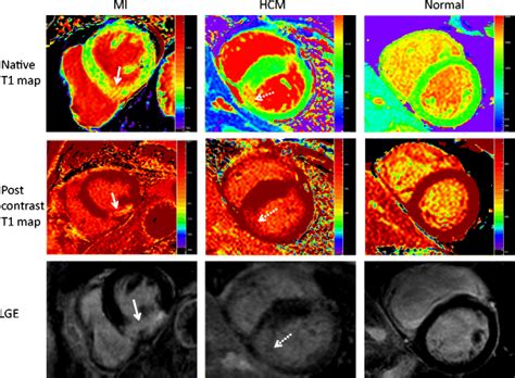 Examples Of Native T1 Mapping T1 Mapping After Contrast And Late