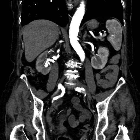 Triple Balloon Assisted N Butyl 2 Cyanoacrylate Embolization Of A