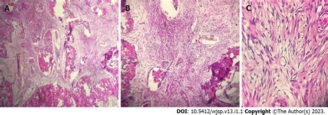 Cemento Ossifying Fibroma Of The Left Mandible A Case Report