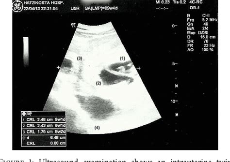 Figure 1 From Heterotopic Triplet Pregnancy After In Vitro