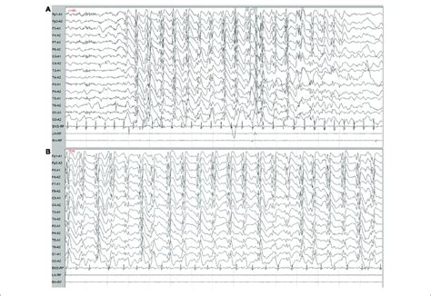 Eeg Demonstrated Generalized Slow Spike And Wave Complexes 1 6 2 Hz