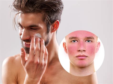 8 Ways To Reduce Rosacea Red Cheeks ~ The Male Grooming Review