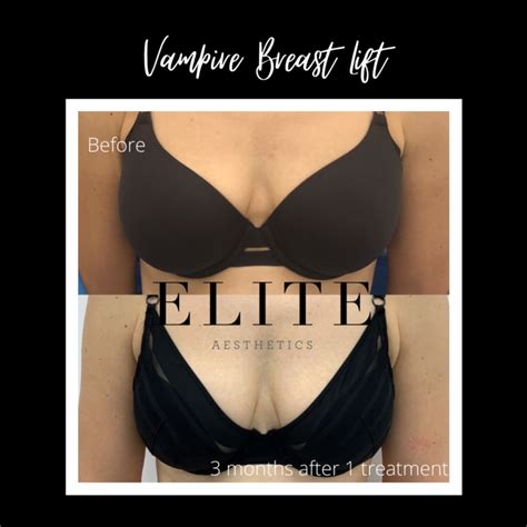 Vampire Breast Lift Uk Perkier Cleavage Elite Aesthetics