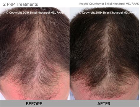 Platelet Rich Plasma Prp For Hair Loss New City Ny Dermatologist