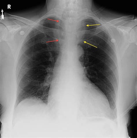 Widened Superior Mediastinum Radiology At St Vincents University