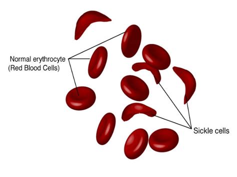 What Is Sickle Cell Diseases Healthy Living