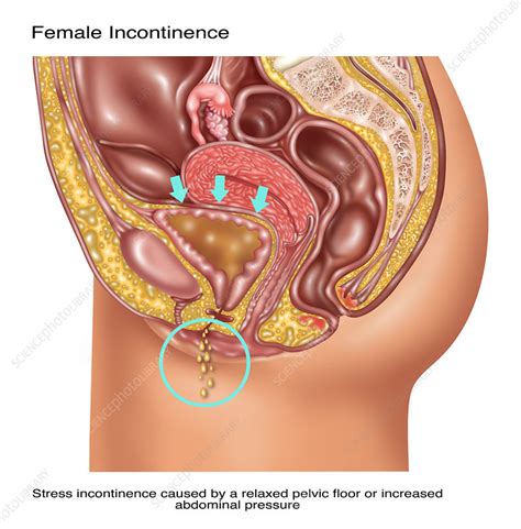 Stress Incontinence In Female Anatomy Stock Image F031 7013
