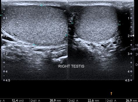 Scrotal Pearls Image