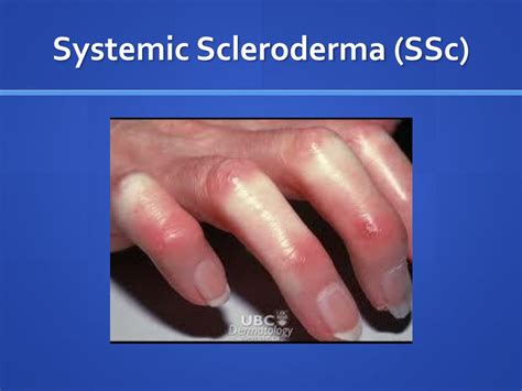 Systemic Sclerosis