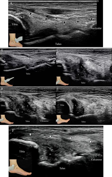 Deltoid Ligament Ultrasound