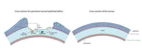 Depiction Of A Persistent Epithelial Defect Ped Note That In The